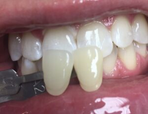 Dr. Piehslinger Zahnarzt | sanftes effizientes Bleaching mit LED