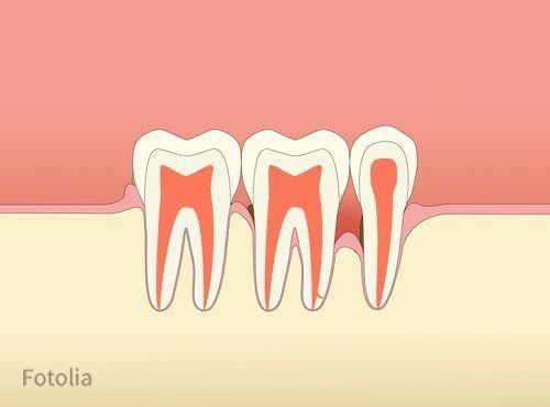 Parodontitisbehandlung Wien | Spezialist Zahnarzt Dr. Piehslinger